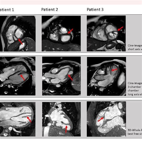 Presentation Of Double Chambered Left Ventricle In Cardiovascular
