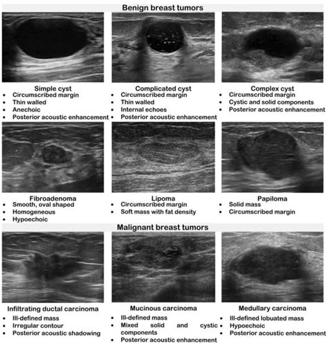 유방 초음파 유방 검사 및 질환 유방암 바로알기