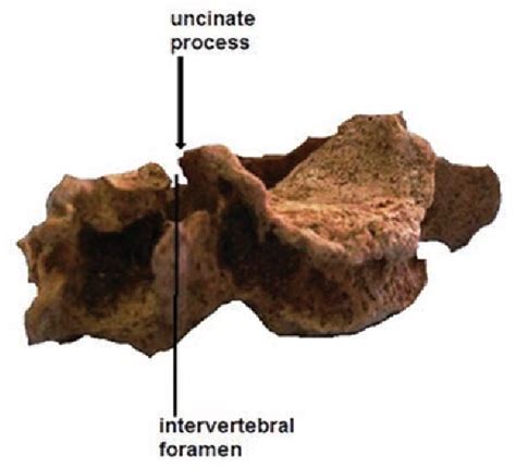Figure 1 From Morphometric Study Of Uncinate Process Of Cervical