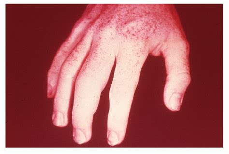 Crohns Disease And Indeterminate Colitis Abdominal Key