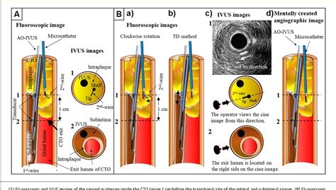 Figure 1 From Tip Detectionantegrade Dissection And Re Entry With New