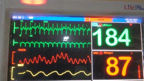 Supraventricular Tachycardiasvt In Cardiac Monitor Youtube