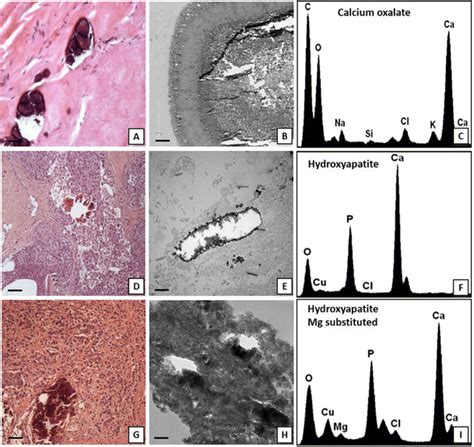 Elemental Composition Of Calcification In Breast Pathology Benign Download Scientific Diagram