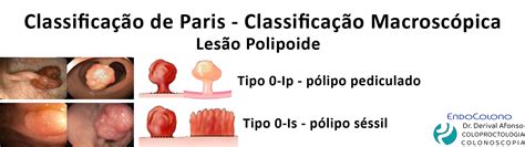 Polipo Colorretal Colonoscopia Coloproctologia Endoscopia