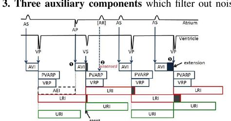 Pacemaker Timing Cycles 2 Atrio Ventricular Interval Avi