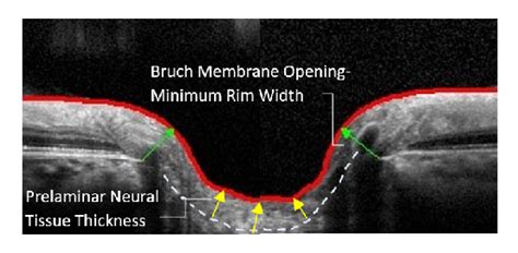Bruchs Membrane Opening Minimum Rim Width Green Arrow And Prelaminar