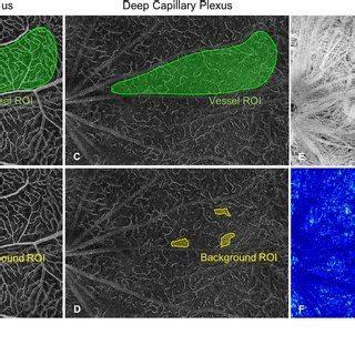 OCTA Quantification On The Retinal Plexuses And The Choroidal Plexus Download Scientific Diagram