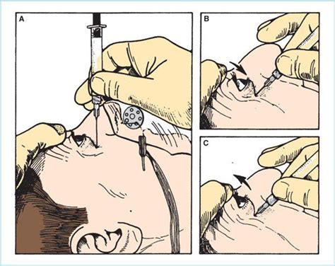 Ophthalmic Anesthesia Anesthesia Key