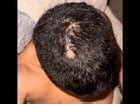 Bald Patch In Pubic Hair R Alopecia Areata