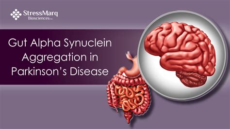 Gut Alpha Synuclein Aggregation In Parkinsons Disease