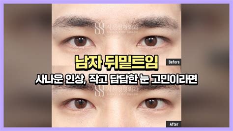 남자뒤밑트임 듀얼트임 사나운 인상 작고 답답한 눈 고민이라면 Youtube