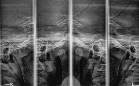 Tmj View Open And Closed Mouth Showing Condylar Dislocation Download Scientific Diagram