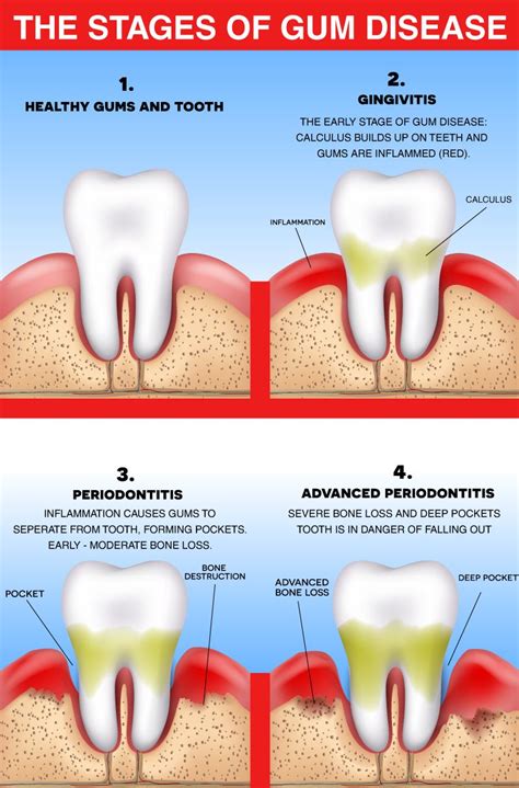 Gum Disease Stages