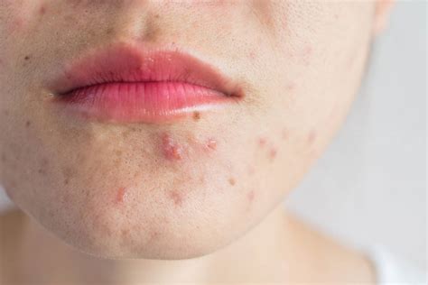 Acne And Early Treatment Hope Dermatology