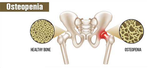 Osteopenia Definition Causes Prevention Diet Symptoms Diagnosis