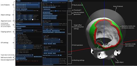 논문 리뷰 A Semi Automatic Cranial Implant Design Tool Based On Rigid Icp Template Alignment And