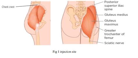Butt Filler Injections Types Procedure Costs Risks And More Dermax