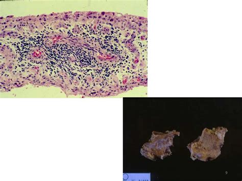 Rheumatoid Arthritis Pathology Cf And Diagnosis And Mxppt