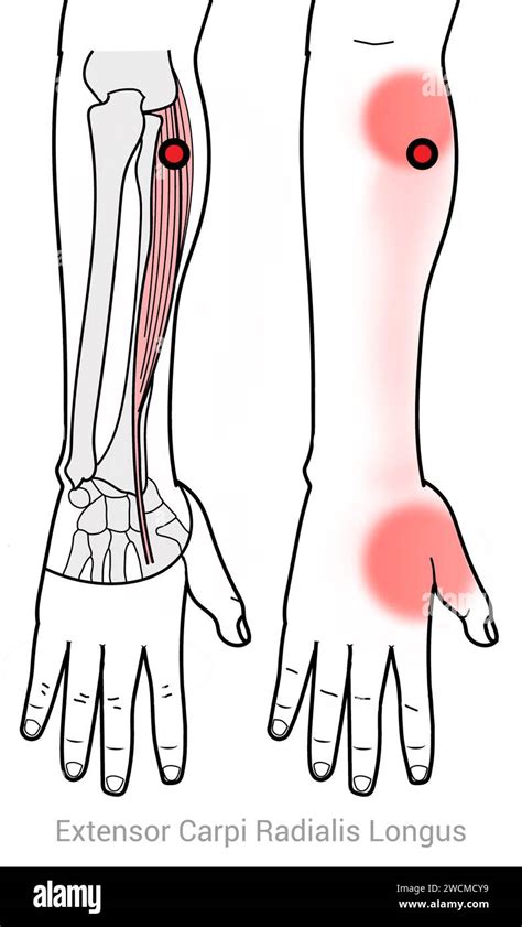 Extensor Carpi Radialis Myofascial Trigger Points And Associated Pain