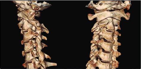 Cervical Spine Ct Scan