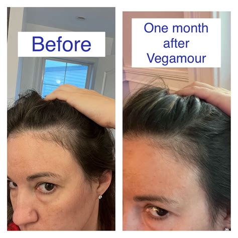 Biotin Before And After Results