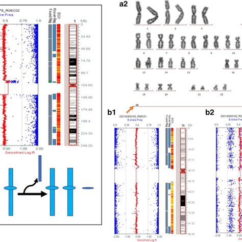 Cytogenetic And Snp Array Results Of Upd Combined With Chromosomal