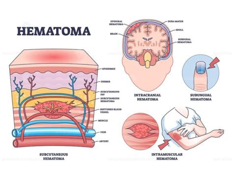 Hematomadiagramoutline Shows Types Of Hematomas With Labeled Sections