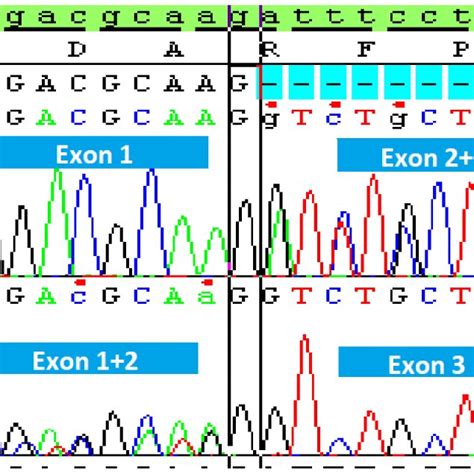 Sanger Sequencing Of Cdna After The Rt‐pcr And Nested Pcr A