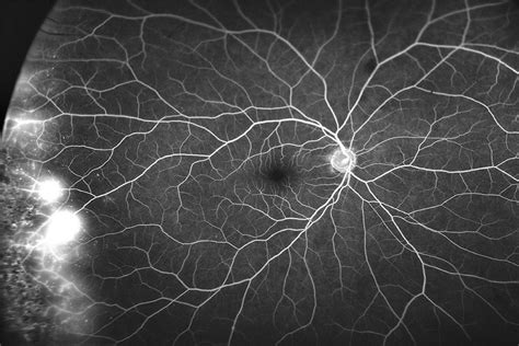 Case Report Peripheral Retinal Ischemia And Retinal Neovasc