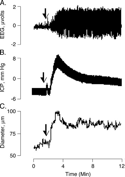 Representative Simultaneous Recordings Of Eeg A Intracranial Download Scientific Diagram