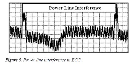 detecting and classifying ecg abnormalities using a multi model methods