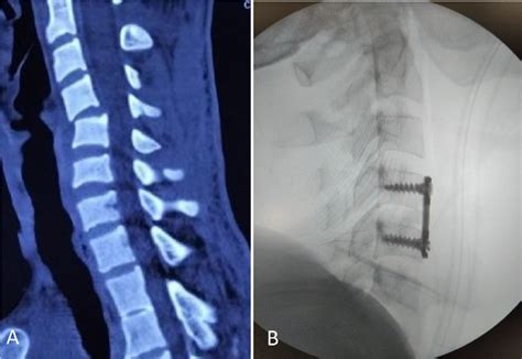 A Ct Image In Sagittal Reconstruction Where A C4 5 Dislocation Is Download Scientific Diagram