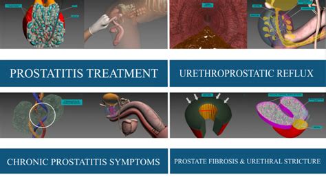 Prostatitis Explained 3d Animations Georgiadis Urology