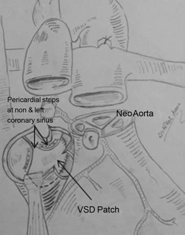 Arterial Switch Operation For Double Outlet Left Ventricle The Annals