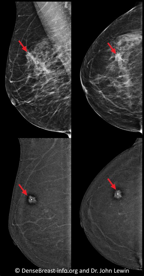 Contrast Enhanced Mammography Cem Densebreast Info Inc