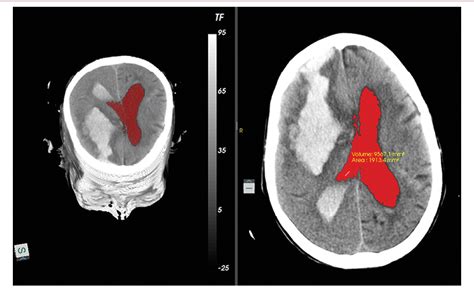 Figure 4 From Brain Morphometry In Adult Volumetric Visualization As A Tool In Image Processing