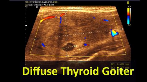 Ultrasound Cases 39 Of 2000 Video Showing Diffuse Thyroid Goiter With Cystic Nodule Youtube