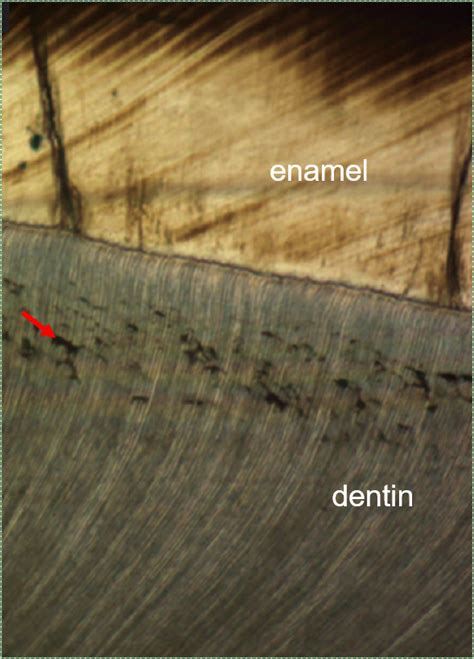 Sclerotic Dentin