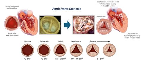 Aortic Stenosis Management Of Asymptomatic Severe Aortic Stenosis