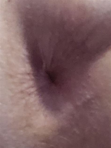 My Jew Butt Hole Pic