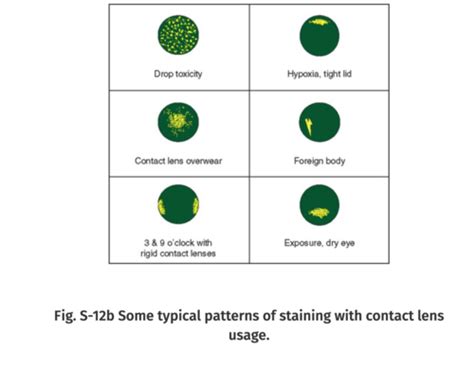 Superficial Punctate Keratopathy Spk Flashcards Quizlet