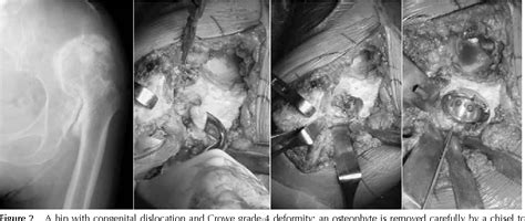 Structure Of Transverse Acetabular Ligament Semantic Scholar