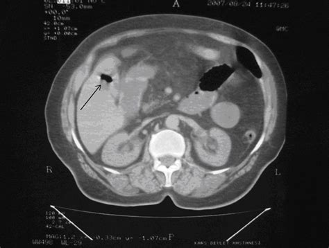 Diagram Of Gallbladder Fossa