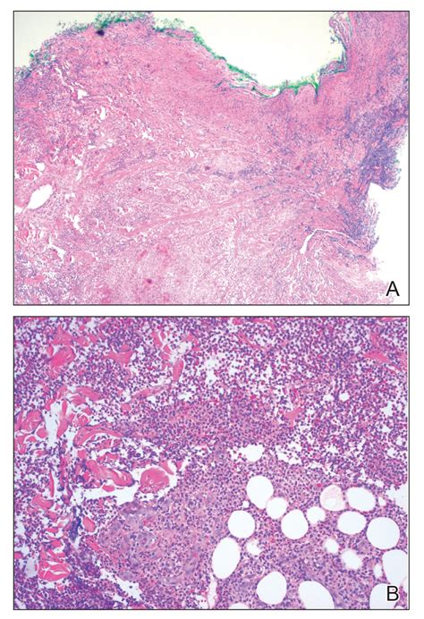 Pyoderma Gangrenosum Developing After Chest Tube Placement In A Patient With Chronic Lymphocytic