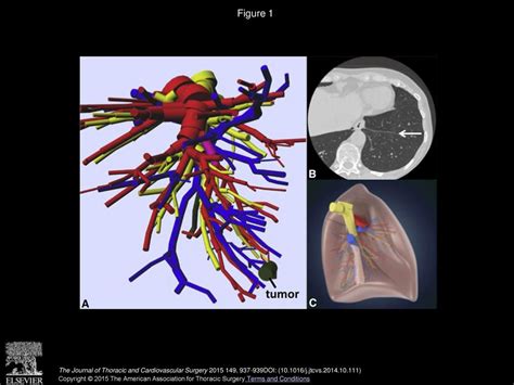 Complete Thoracoscopic S9 Or S10 Segmentectomy Through A Pulmonary Ligament Approach Takuma