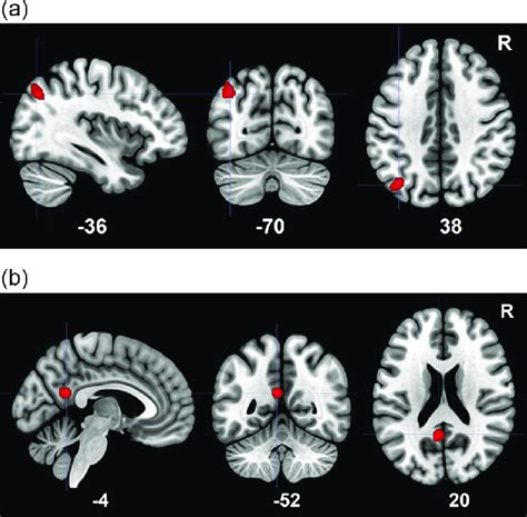 Results From Seed Based Analysis Of Resting State Data On The Mni