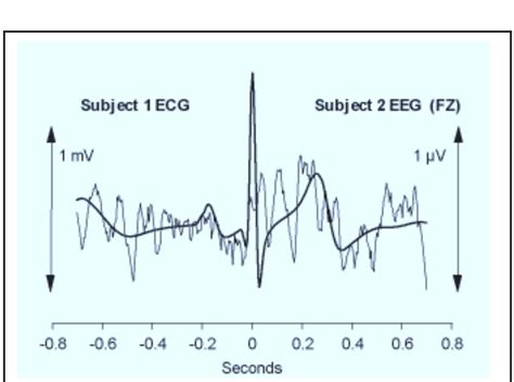 Overlay Of Signal Averaged Eeg And Ecg This Graph Is An