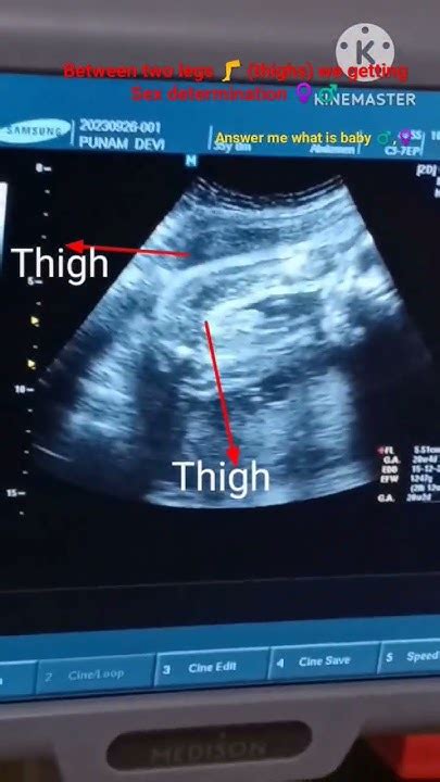 Sex Determination ♀️♂️ Radiography Youtubeshorts Youtube