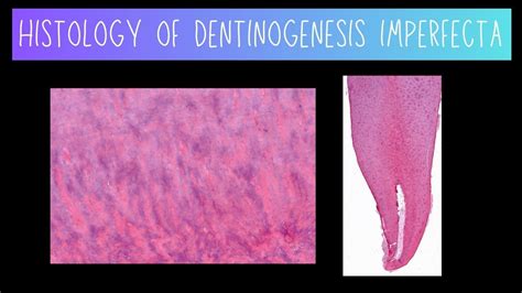 Histology Of Dentinogenesis Imperfecta Youtube