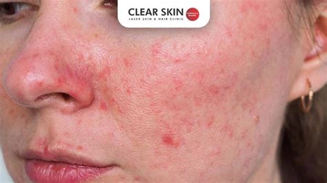 Red Acne Marks Causes And Treatments Clear Skin Clinic